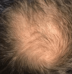 La calvitie vertex : causes et solutions - Hair Repair