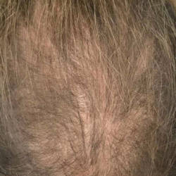 La calvitie diffuse : causes et solutions - HRS