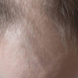 La calvitie frontale : Causes et solutions - Hair Repair