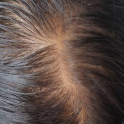 La calvitie chez la femme : causes et solutions - Hair Repair