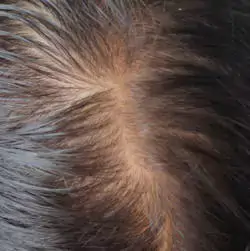 La calvitie chez la femme : causes et solutions - Hair Repair